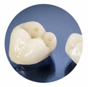 Dental crown manufacturing – The 3 W's - Telcon Diamond Cutting Tools