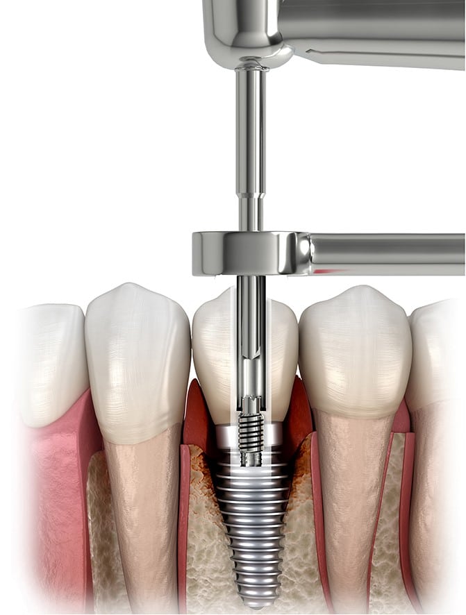 Dental Screw Removal Kit - Telcon Diamond Cutting Tools
