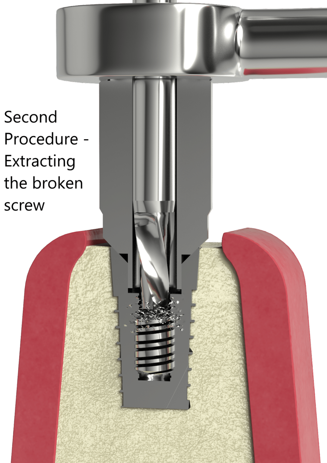 Dental Screw Removal: A Revolution with Telcon's BHI Screw Removal Kit ...